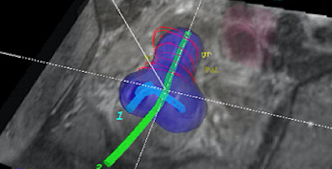 Βραχυθεραπεία - Αναστασία Στεργιούλα, MD