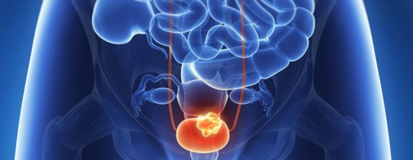 Καρκίνος Ουροδόχου Κύστης - Αναστασία Στεργιούλα, MD